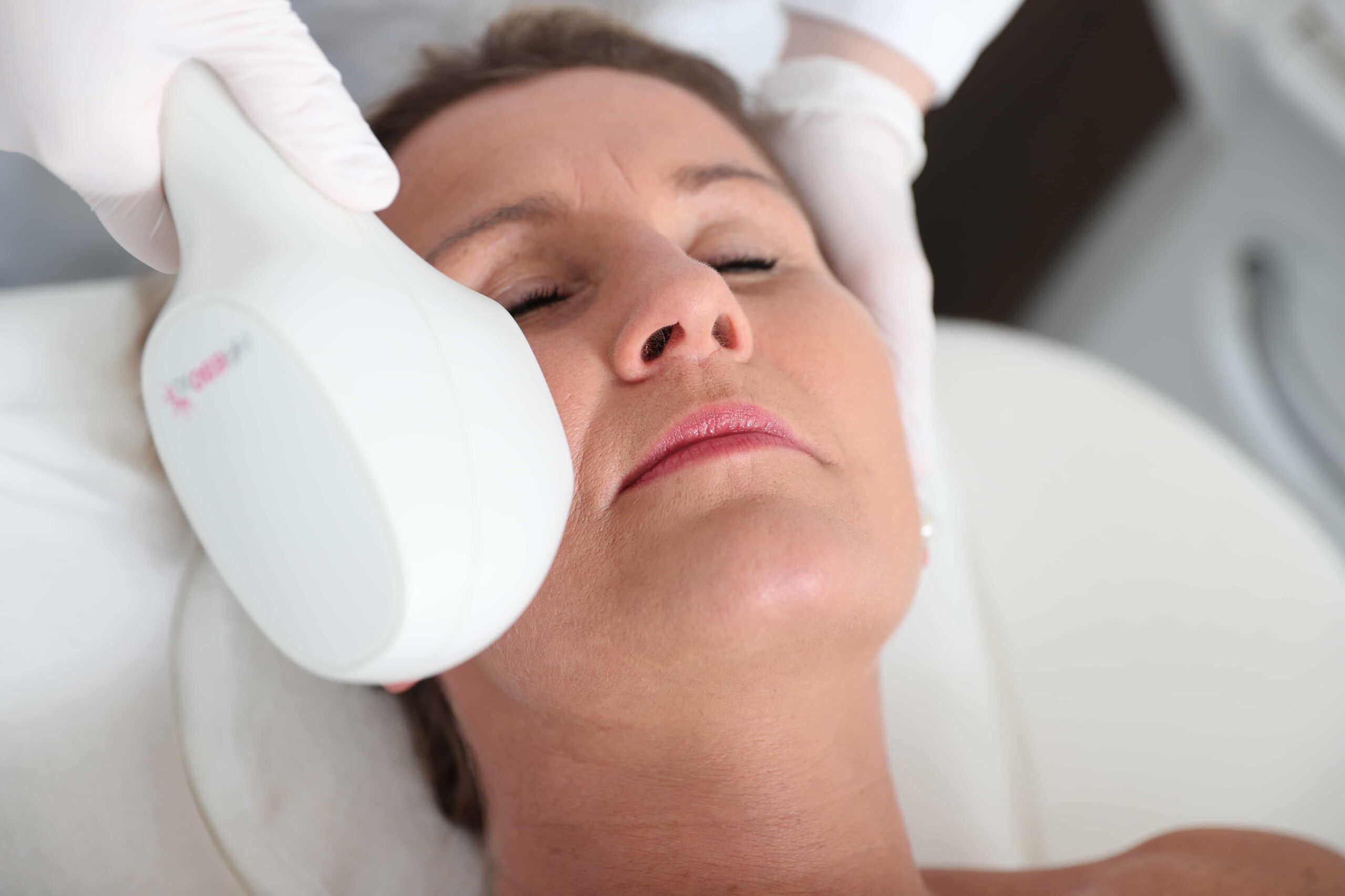 Photorejuvenation | IPL gehele gezicht (excl. oorschelpen en hals ...